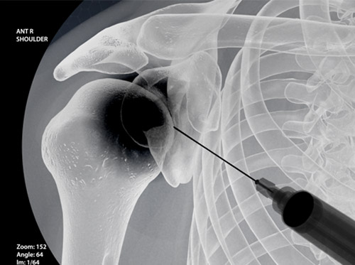 Video - Joint Injection (Therapeutic, Shoulder) - HealthClips Online