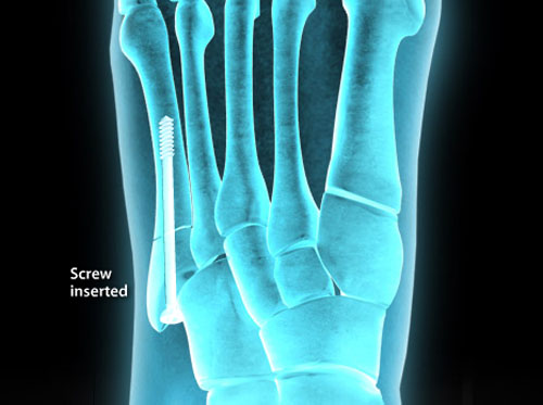 Video - Jones Fracture Fixation (Intramedullary Screw) - HealthClips Online