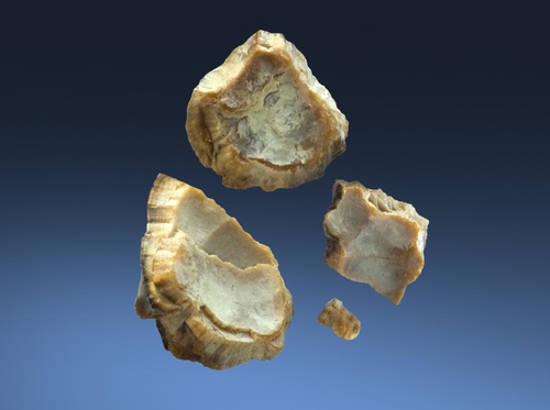 Video - Lithotripsy (Overview) - HealthClips Online