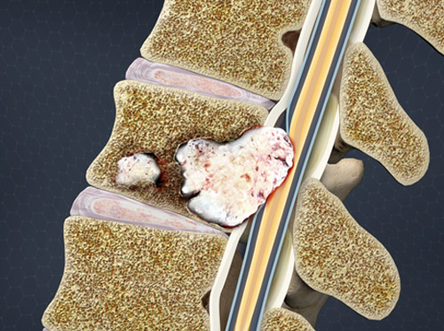 Video - Metastatic Cancer of the Spine - HealthClips Online