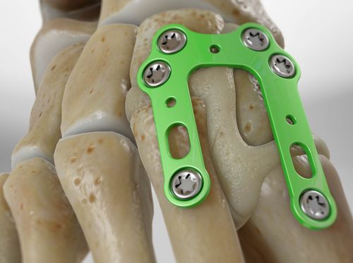 Video - Midfoot Fusion - HealthClips Online