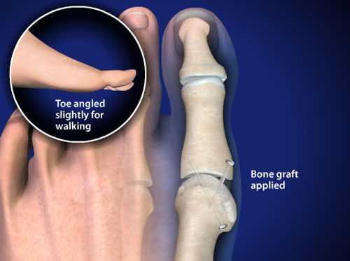 Video - Big Toe Fusion (First Metatarsal-Phalangeal Joint Arthrodesis ...