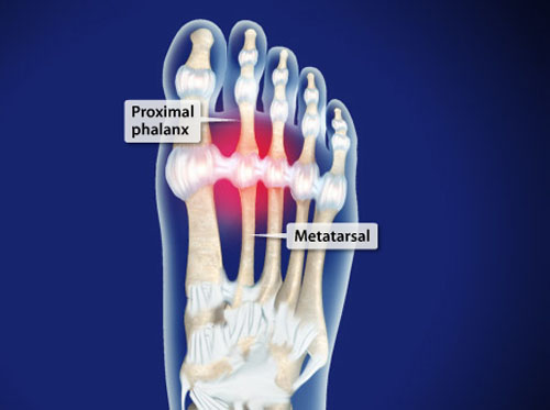 Video - MTP Synovitis (Capsulitis) - HealthClips Online