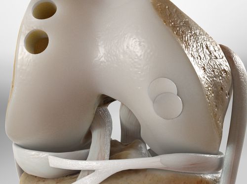 Video - Osteoarticular Transfer System (OATS) - HealthClips Online