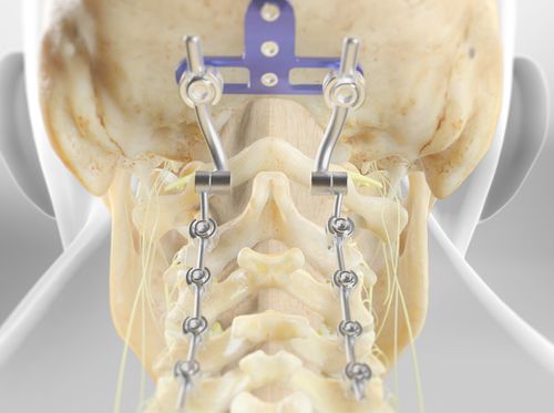 Video - Occipito-Cervical Fixation (OC Fusion) - HealthClips Online