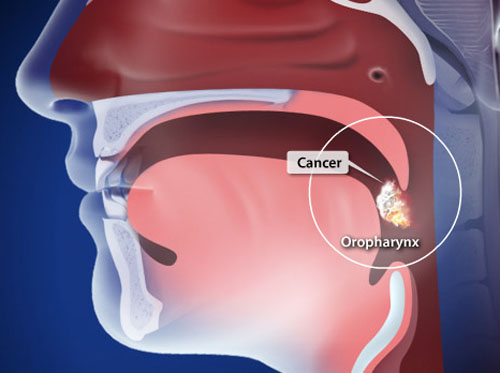 Video - Oropharyngeal Cancer - HealthClips Online