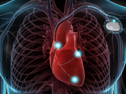 Video - Pacemaker (Overview) - HealthClips Online