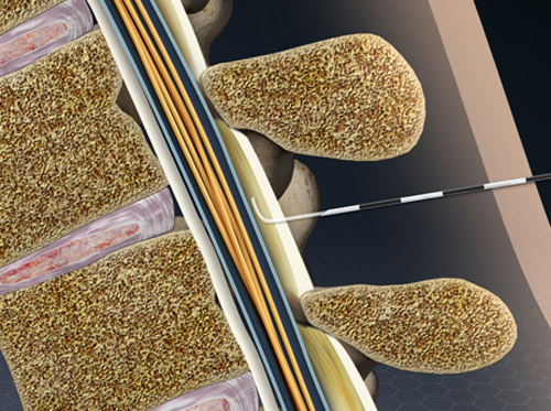 Video - Patient-Controlled Epidural Analgesia (PCEA) - HealthClips Online