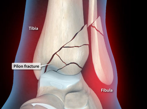 Video - Pilon Fractures - HealthClips Online
