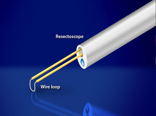 Video - Polypectomy (Hysteroscopic Resectoscope) - HealthClips Online