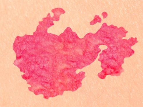 Video - Port-wine Stain - HealthClips Online