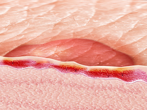 Video - Pressure Ulcers - HealthClips Online