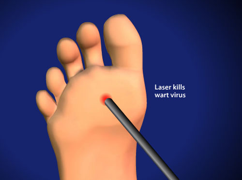 Video - Pulse Dye Laser Wart Removal - HealthClips Online
