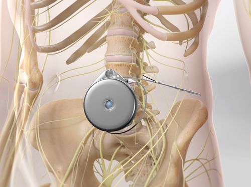 Video - Intrathecal Pump Implant - HealthClips Online