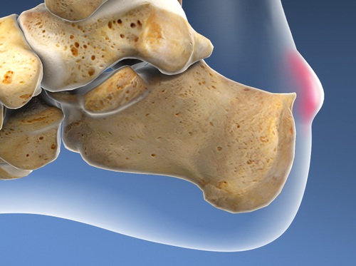 Video - Haglund's Deformity Surgery (Resection Method) - HealthClips Online