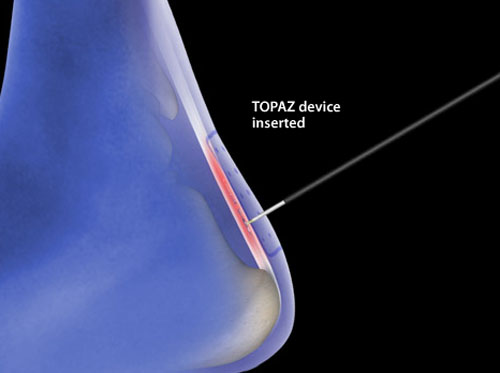 Video - Radiofrequency Treatment for Plantar Fasciitis (TOPAZ ...