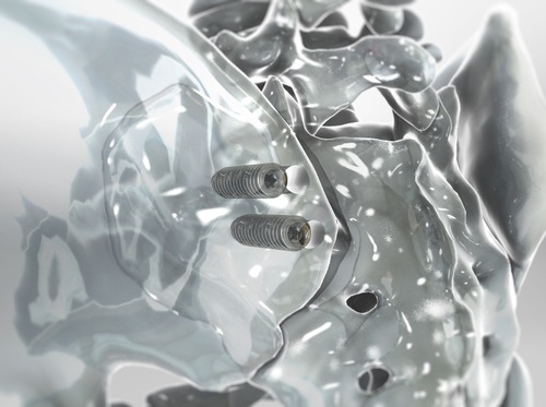 Video - Sacroiliac Joint Fusion (Rialto™ SI Fusion System ...