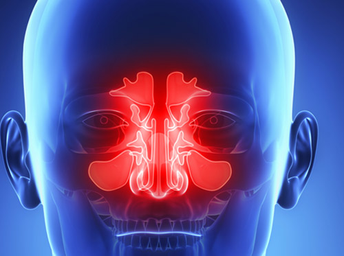 Video - Sinusitis (infección de los senos paranasales) - HealthClips Online