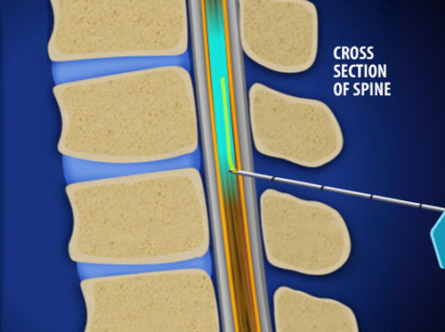 Video - Spinal Anesthesia for Hip and Lower Extremity - HealthClips Online