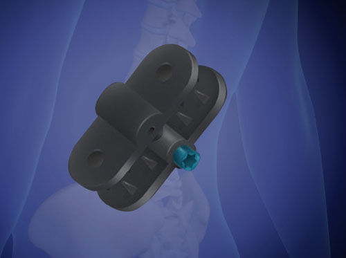 Video - Lumbar Spinous Process Plating (CD Horizon® SPIRE ...