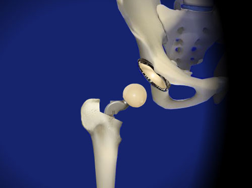 Video - Total Hip Replacement (Margron) - HealthClips Online