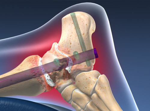 Video - Tibiotalocalcaneal Fusion (with Intramedullary Rod ...