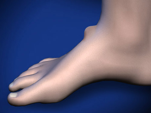 Video - Excision of Soft Tissue Masses - HealthClips Online