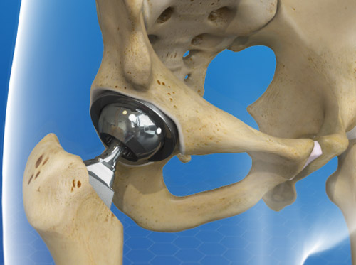 Video - Total Hip Replacement (Metal on Metal) - HealthClips Online