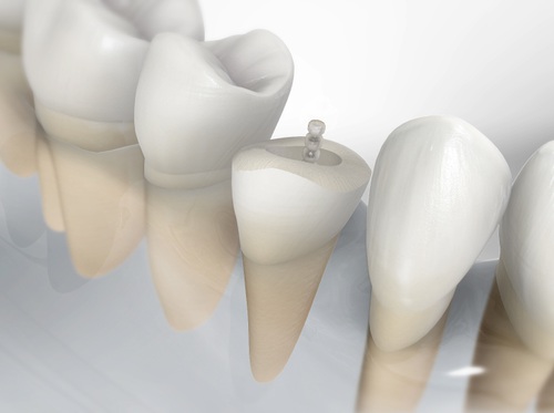 Video - Post and Core Restoration (Prefabricated Post System ...