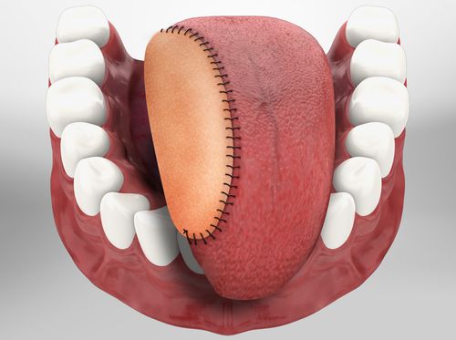 Video - Glosectomía - HealthClips Online