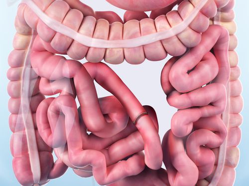 Video - Resección del intestino delgado - HealthClips Online