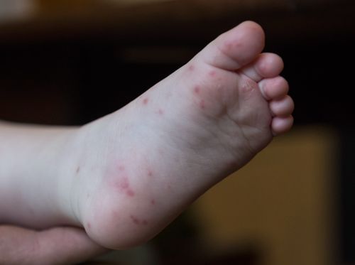 Video - Hand, Foot and Mouth Disease (HFMD) - HealthClips Online