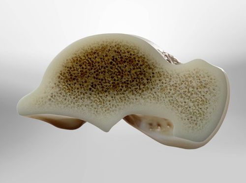 Video - Core Decompression for Avascular Necrosis of the Talus ...