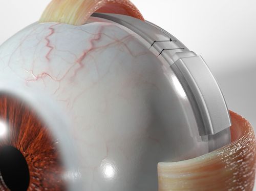 Video - Scleral Buckling - HealthClips Online