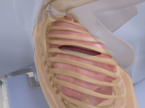 Cicatriz De Toracotomia Cicatrizada