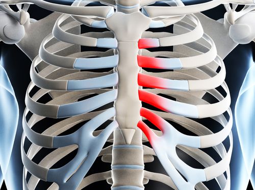 Video - Costochondritis - HealthClips Online